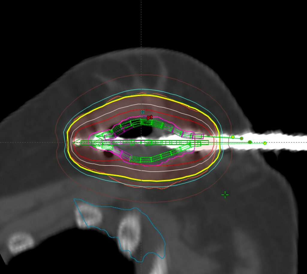 Brachytherapy - Memorial Radiation Oncology Medical Group