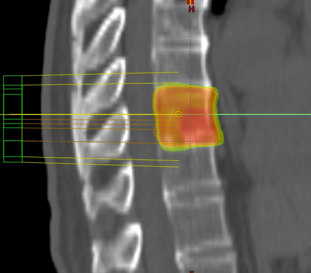 Stereotactic Ablative Radiotherapy - Memorial Radiation Oncology ...