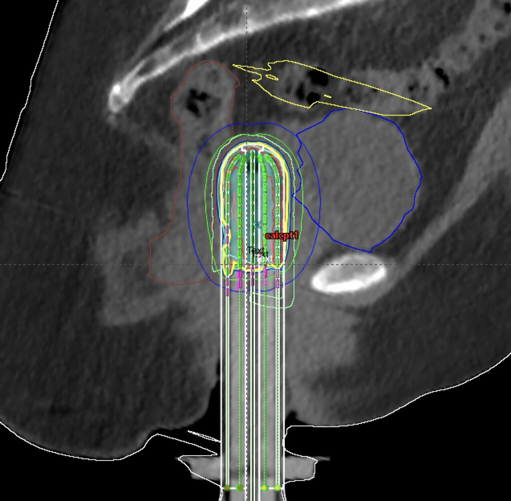 Brachytherapy - Memorial Radiation Oncology Medical Group