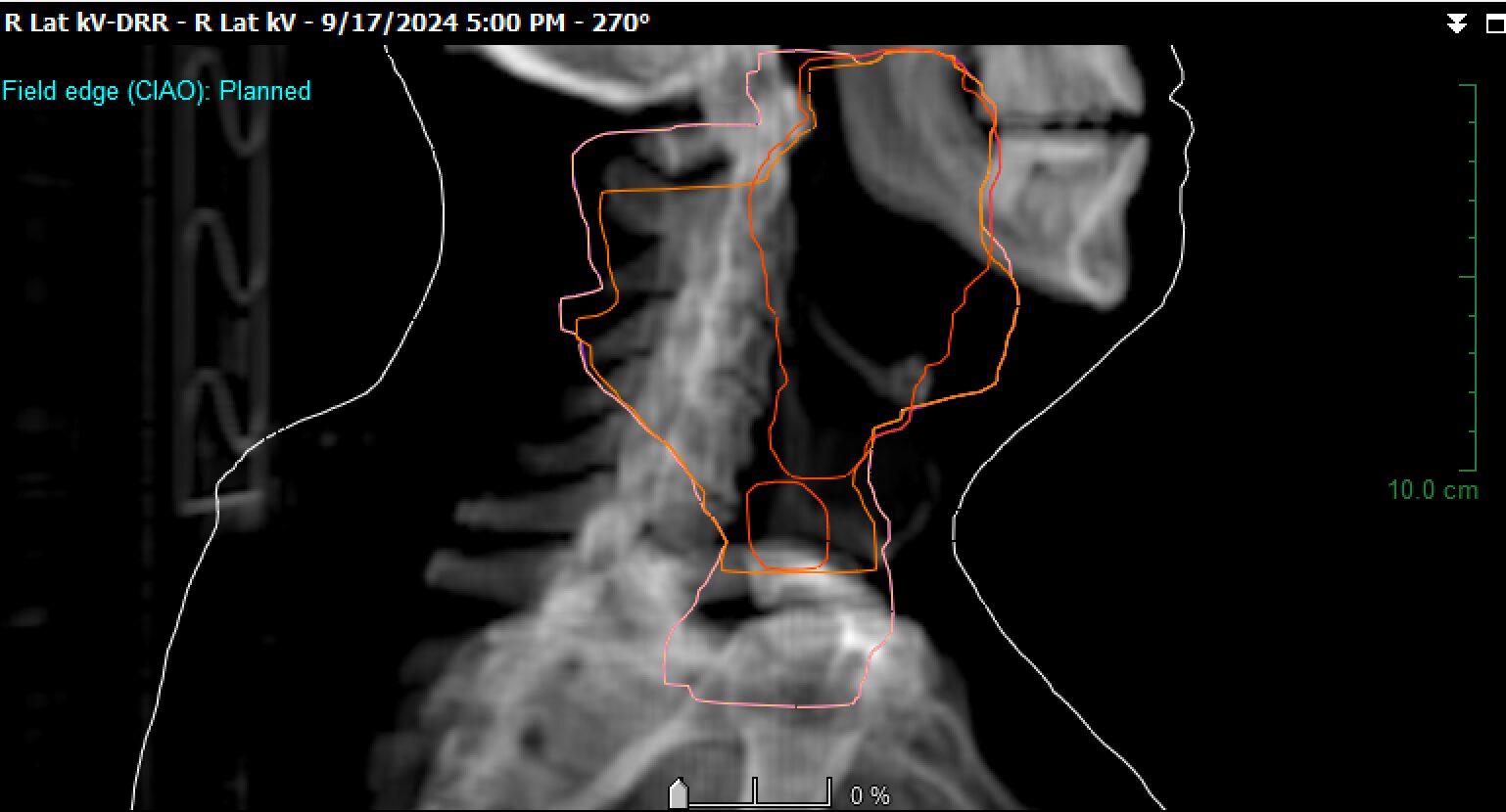 Image guided Radiation Therapy - Memorial Radiation Oncology Medical Group